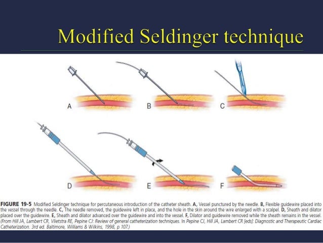 LEFT HEART CATHETERIZATION