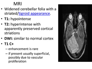 Lhermitte Duclos Disease Radiology ll Dysplastic cerebellar ...