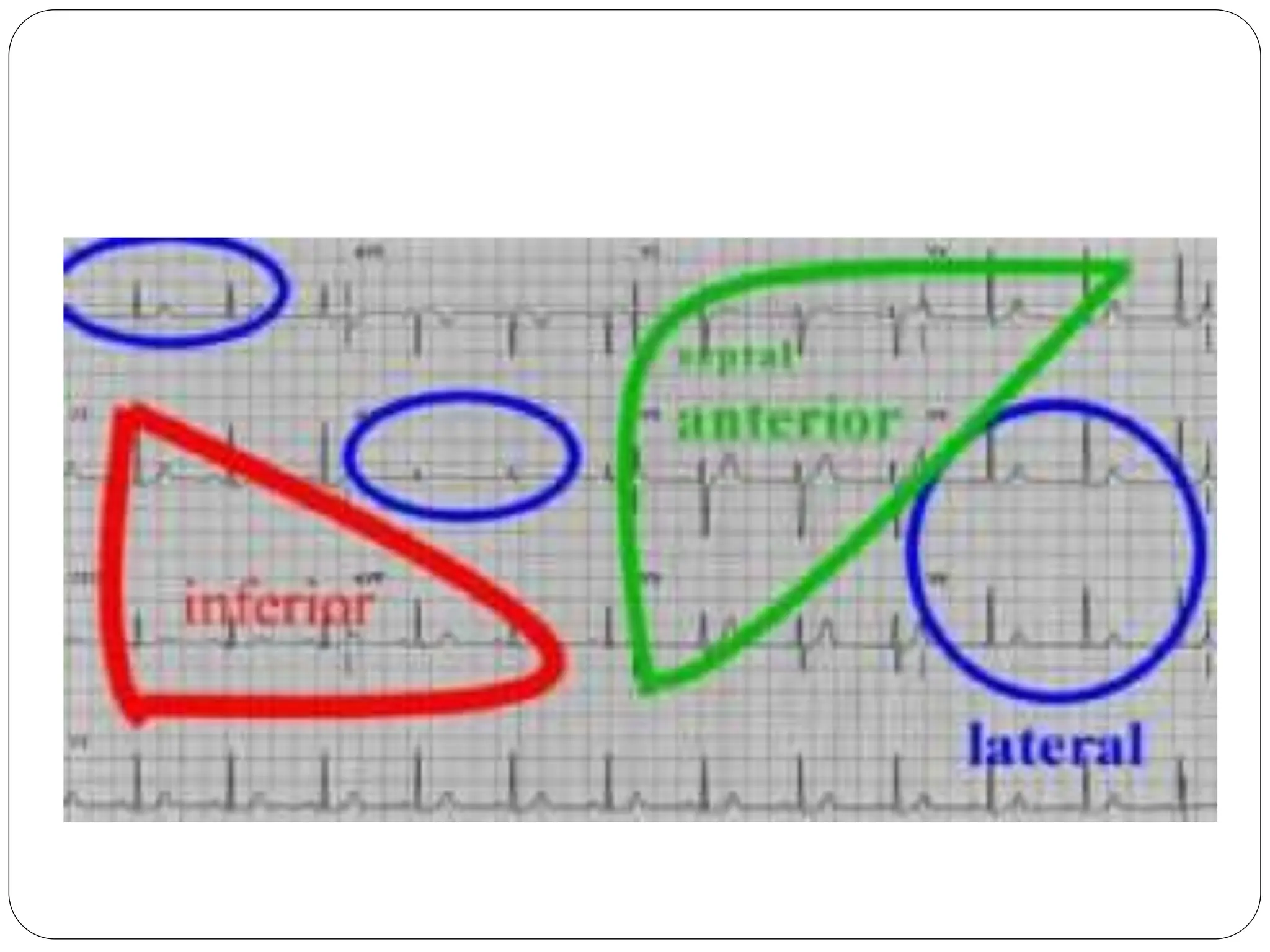 pembacaan dan interpreatsi ekg (cardio).ppt