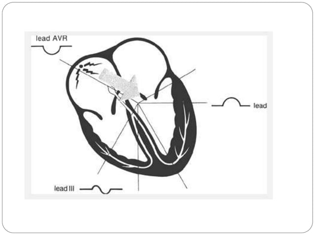 pembacaan dan interpreatsi ekg (cardio).ppt