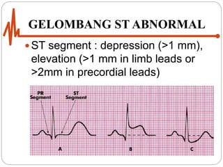 pembacaan dan interpreatsi ekg (cardio).ppt