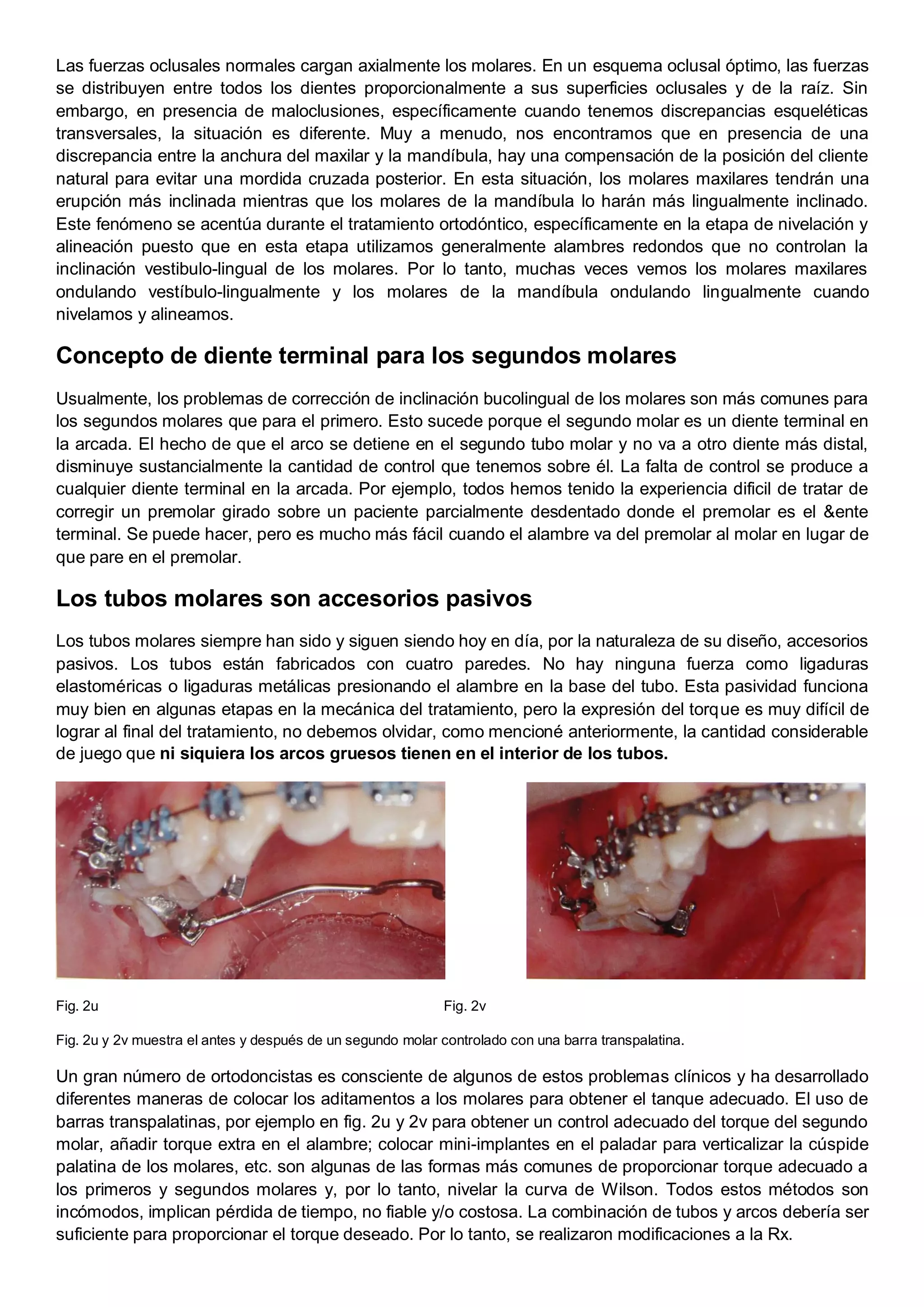 Sistema De Brackets Cco Pdf