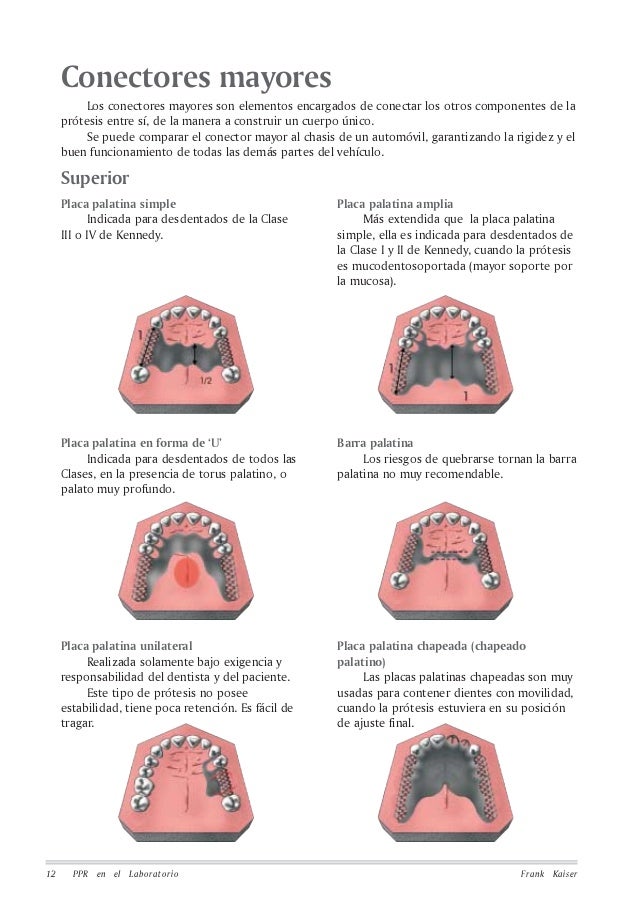protesis parcial removible