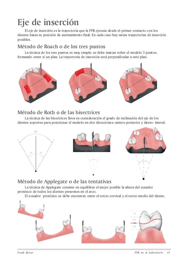 protesis parcial removible