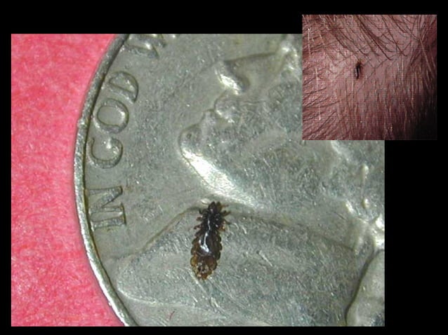 A presentation on Pediculosis capitis (general) | PPT