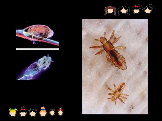 A presentation on Pediculosis capitis (general) | PPT