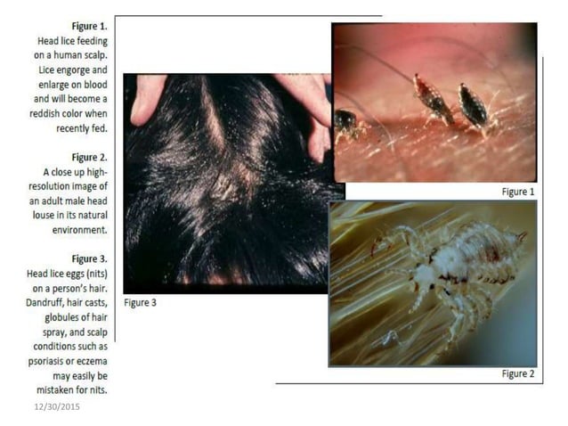 Lice | PPTX | Infectious Diseases | Diseases and Conditions
