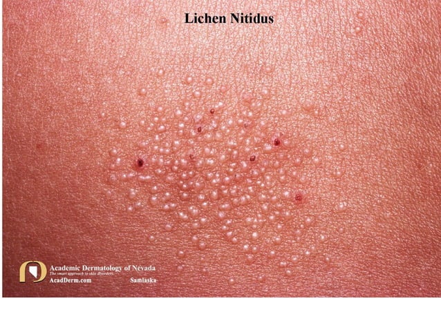 LICHEN NITIDUS by Rejoice-WPS Office.pptx