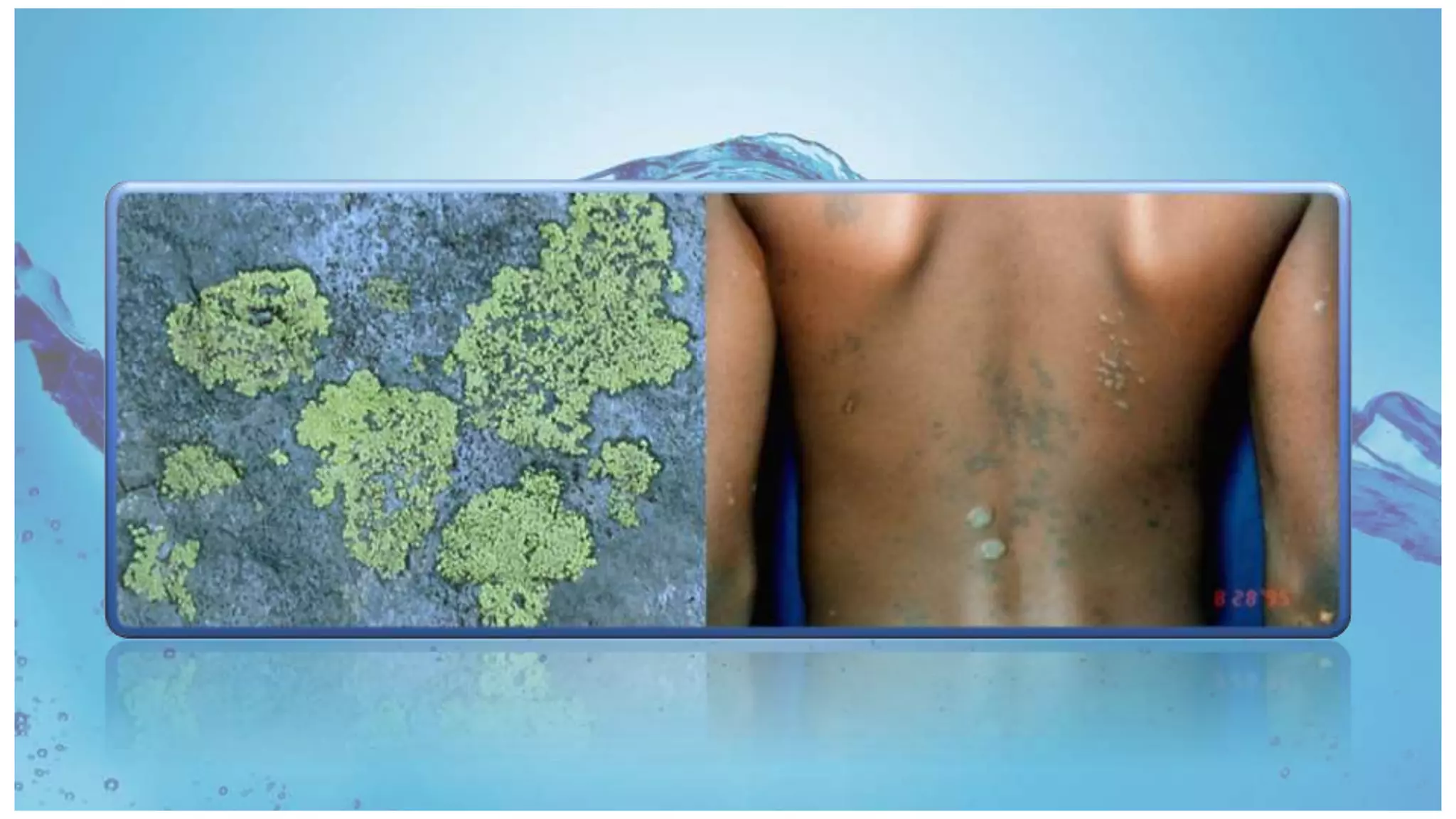 Lichenoid dermatoses.potx