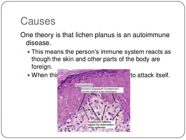 Lichen planus