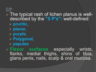 Lichen planus | PPTX