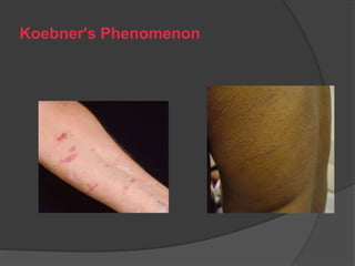 Lichen planus | PPTX