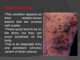 Lichen planus | PPTX