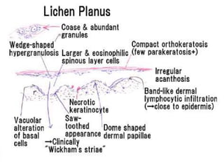Lichen planus | PPTX
