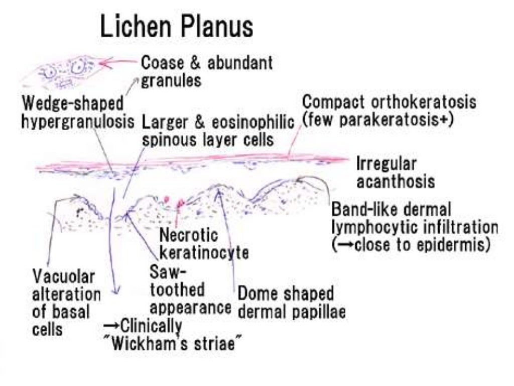 Lichen planus