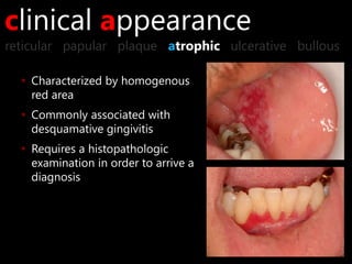 Oral Lichen Planus | PPTX