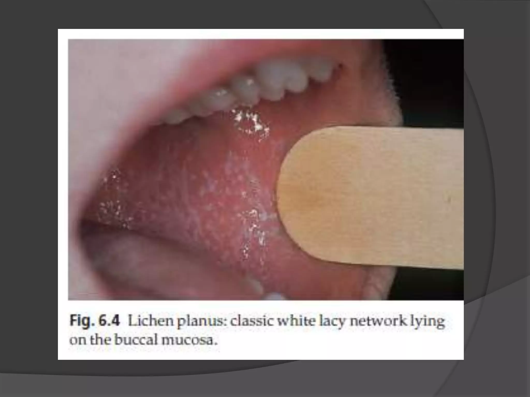 Lichen planus | PPTX