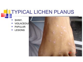 Lichen planus | PPT