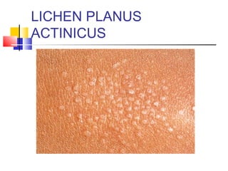 Lichen Planus Actinicus