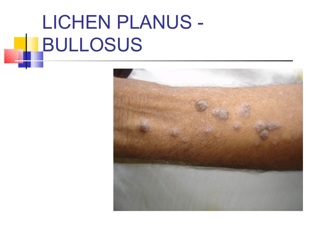 Lichen planus