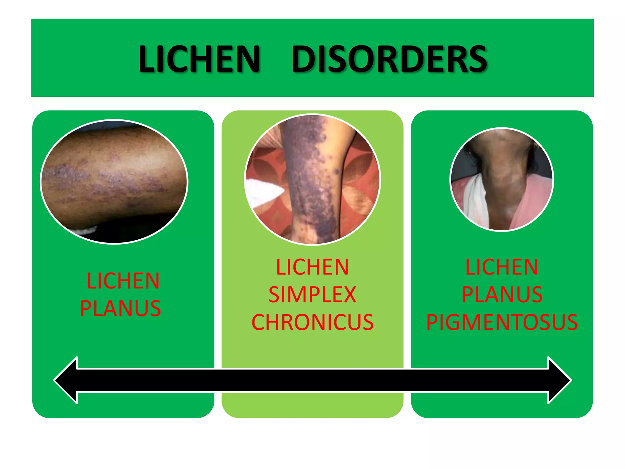 Ayurvedic Treatment for Lichen Planus , PLEVA , Lichen Simplex , LPP ...