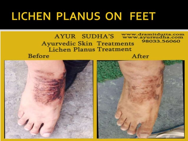 Ayurvedic Treatment for Lichen Planus , PLEVA , Lichen Simplex , LPP ...
