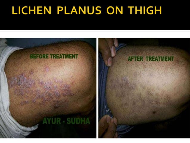 Ayurvedic Treatment for Lichen Planus , PLEVA , Lichen Simplex , LPP ...