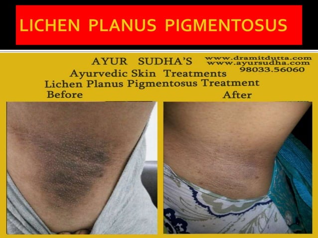 Ayurvedic Treatment for Lichen Planus , PLEVA , Lichen Simplex , LPP ...