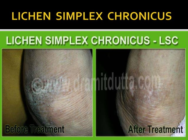 Ayurvedic Treatment for Lichen Planus , PLEVA , Lichen Simplex , LPP ...