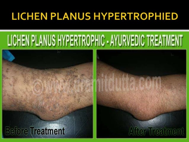 Ayurvedic Treatment for Lichen Planus , PLEVA , Lichen Simplex , LPP ...
