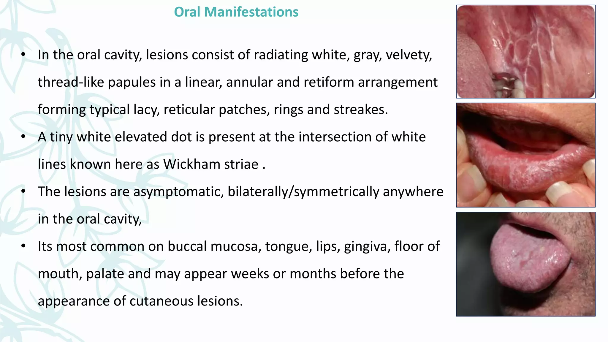 Lichen planus | PPTX