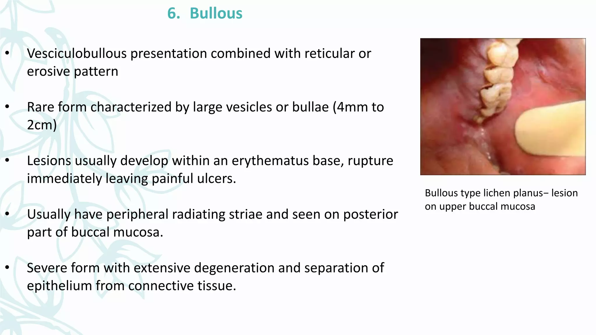 Lichen planus | PPTX
