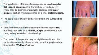 Lichen planus | PPTX
