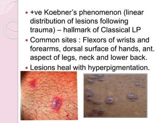 Lichen planus by Dr. Kriti Maheshwari | PPTX