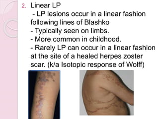 Lichen planus by Dr. Kriti Maheshwari | PPTX