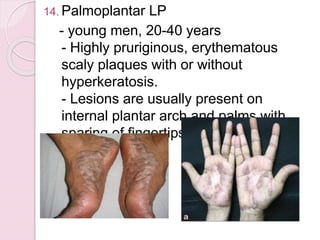 Lichen planus by Dr. Kriti Maheshwari | PPTX