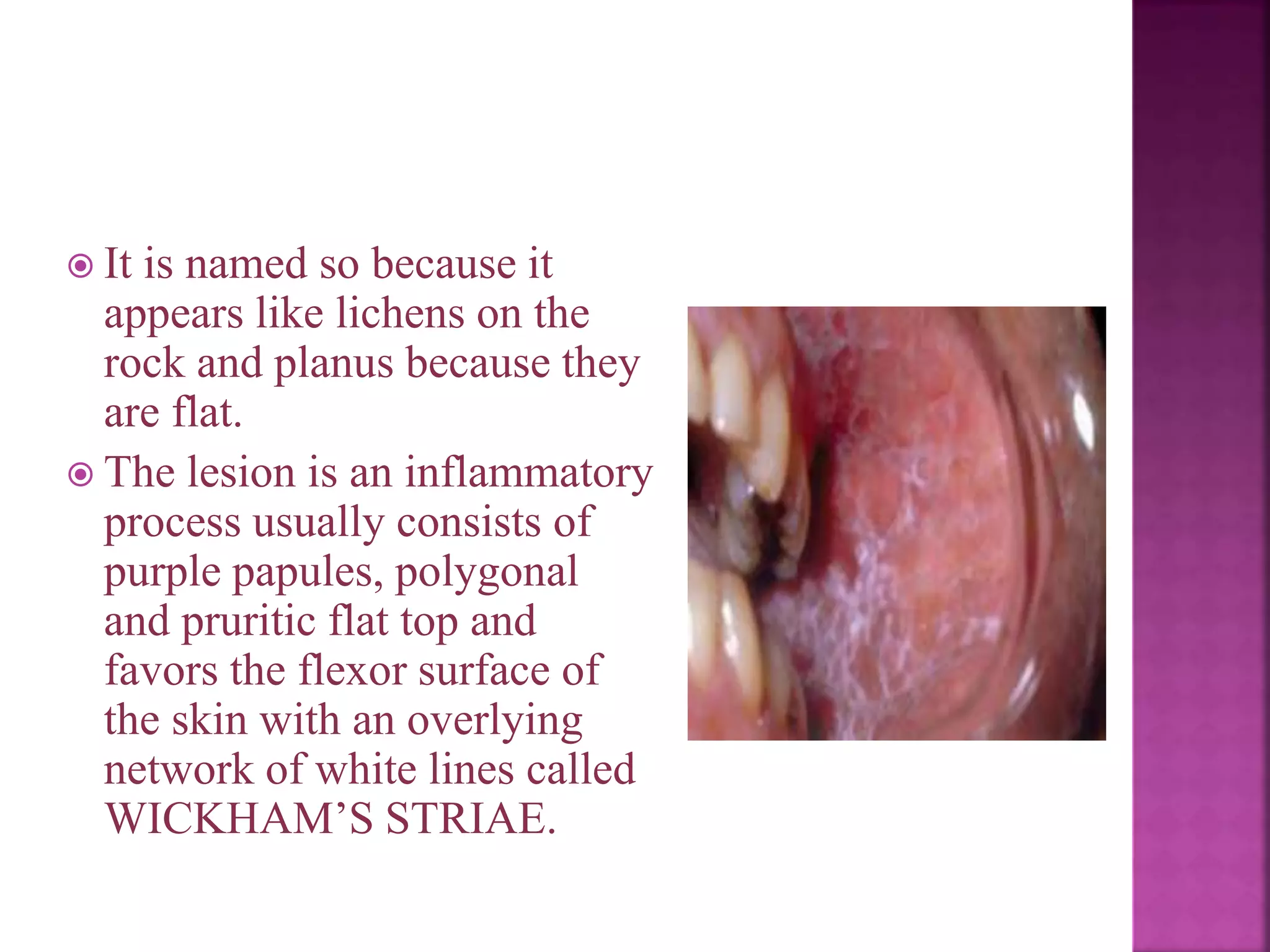 Lichen planus | PPTX