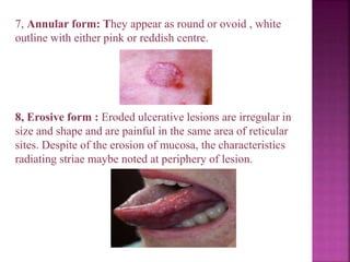 Lichen planus | PPTX