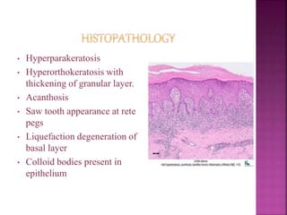 Rete Pegs Lichen Planus