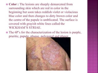 Lichen planus | PPTX