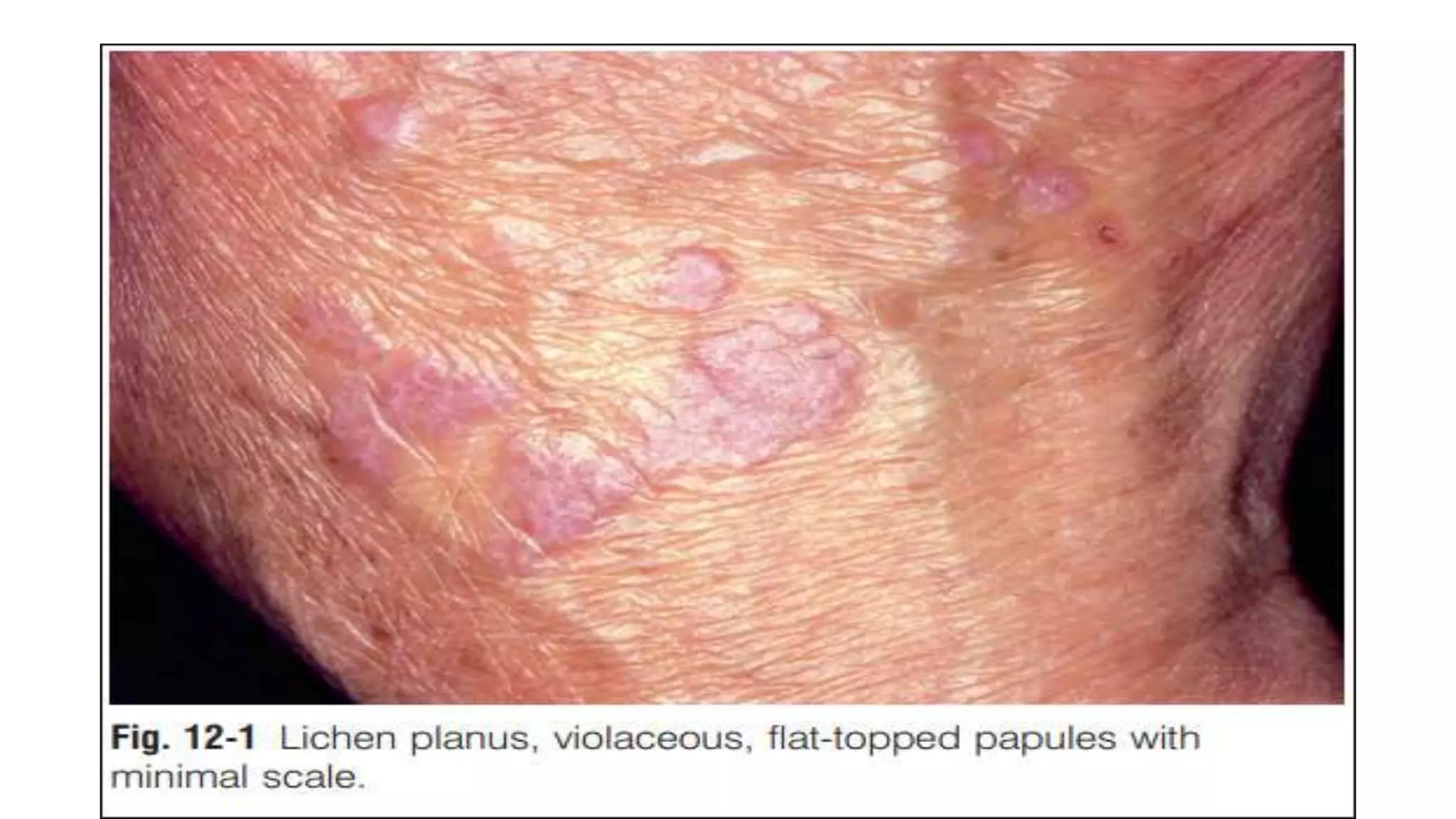 LICHEN PLANUS.pptx
