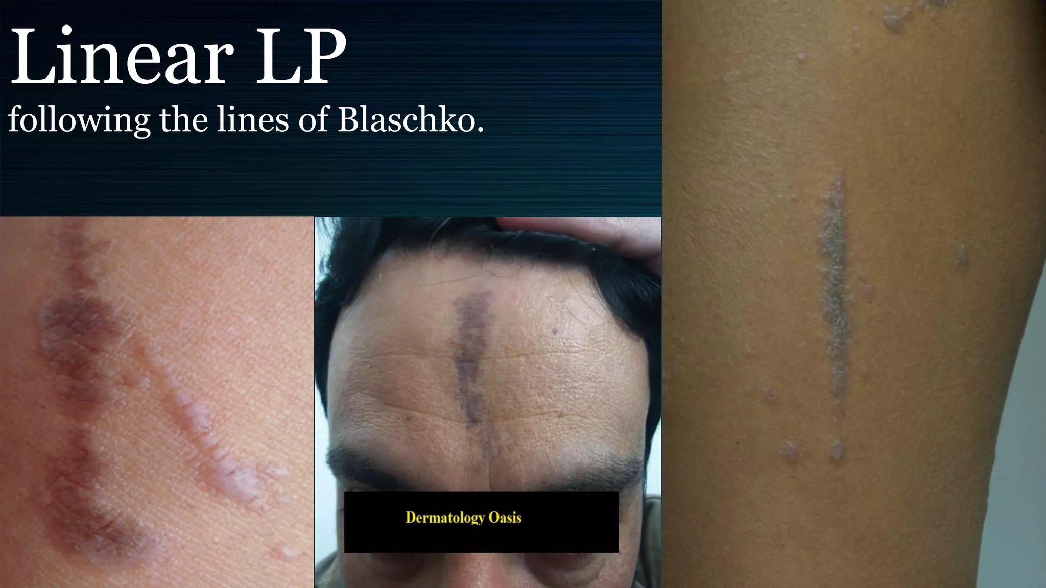 Lichen Planus.pdf