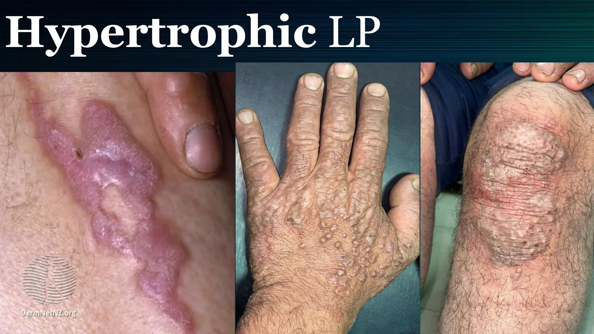 Lichen Planus.pdf