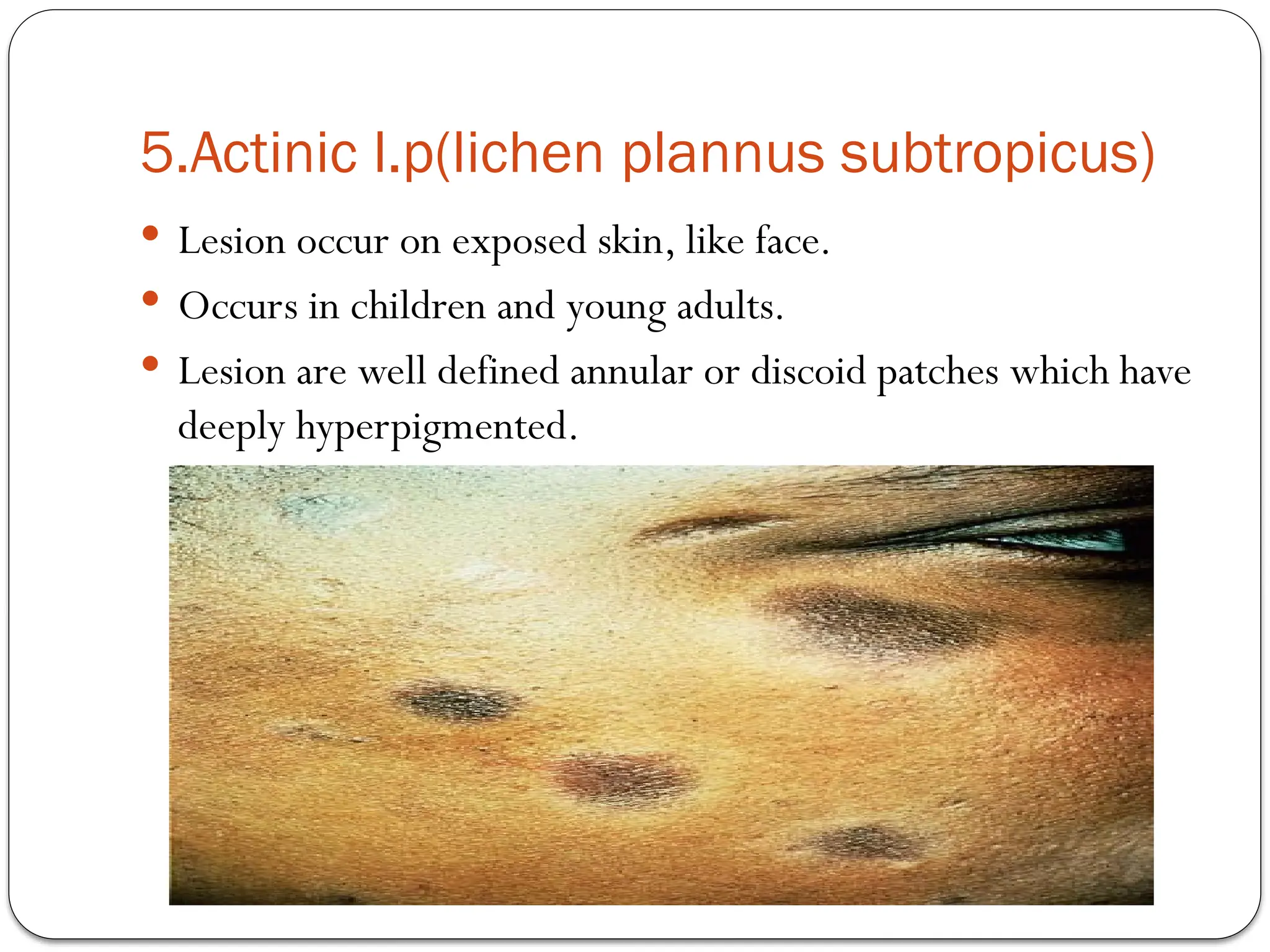 LICHEN PLANUS.presentation ( Skin dieases in deramatology) | PPTX