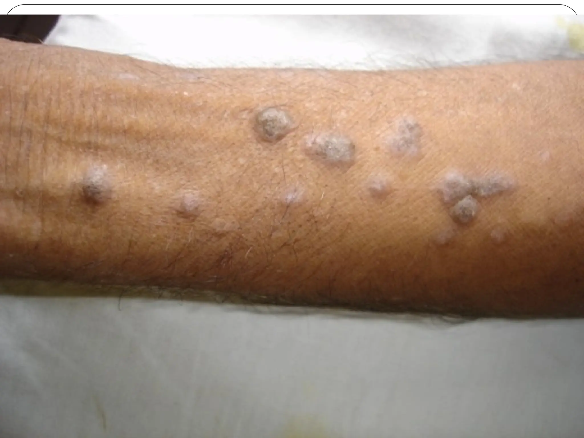 LICHEN PLANUS.presentation ( Skin dieases in deramatology) | PPTX