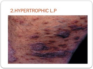 LICHEN PLANUS.presentation ( Skin dieases in deramatology) | PPTX