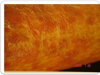 LICHEN PLANUS.presentation ( Skin dieases in deramatology) | PPTX