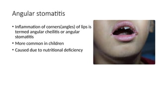 Lichen planus clinical features and histopathology .pptx | Ear, Nose ...