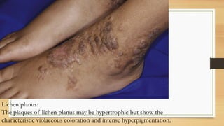 LICHEN PLANUS.pptx, DERMATOLOGY/MEDICINE/MEDICAL STUDENTS | PPTX