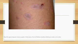 LICHEN PLANUS.pptx, DERMATOLOGY/MEDICINE/MEDICAL STUDENTS | PPTX